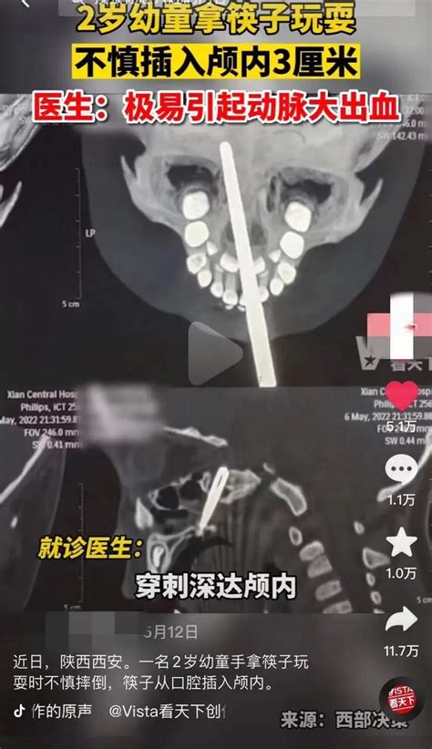 筷子插入2岁幼童颅内3厘米，险引起动脉大出血！伤娃“凶器”黑名单，千万注意