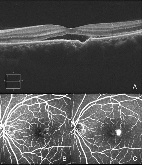 Focal Choroidal Excavation With Concomitant Central Serous Download Scientific Diagram