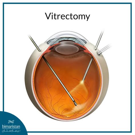 Vitrectomy In Türkiye Bimaristan