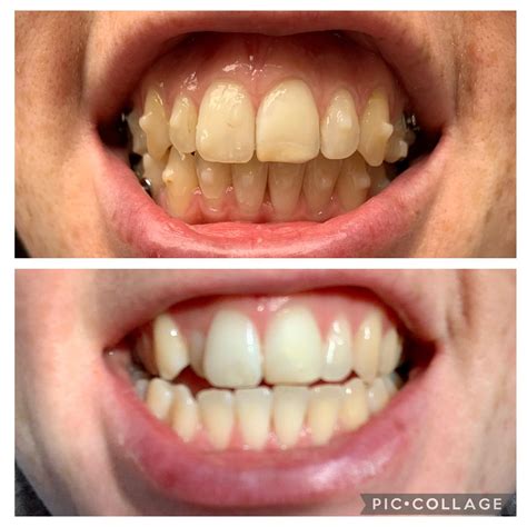 Refinement Progress Thoughts Invisalign
