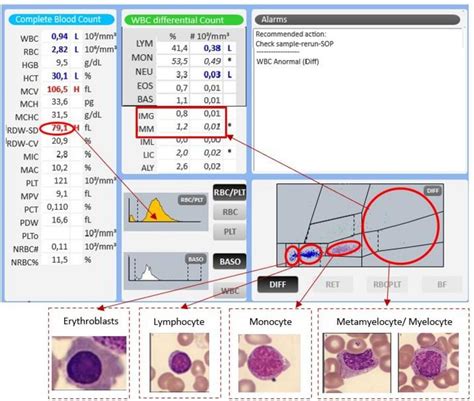 Clinical Case 17 Acute Promyelocytic Leukemia Horiba