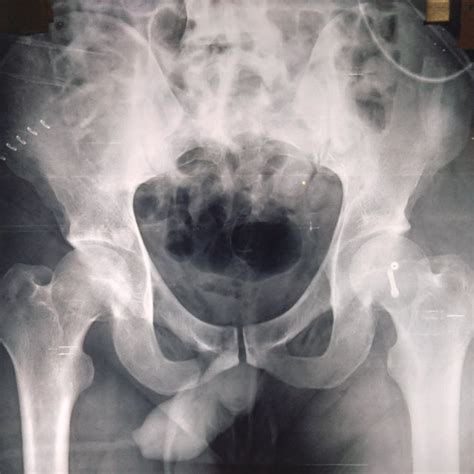 Classification Of Hip Dislocation Thompson And Epstein Download Table