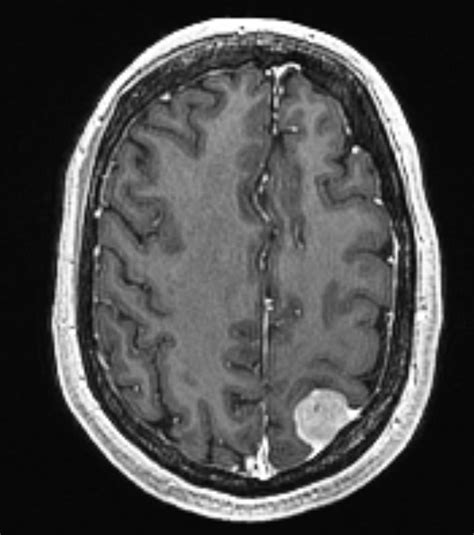 Benign Brain Tumor