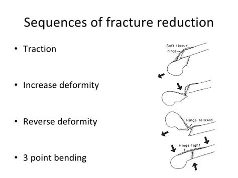 Ortho 03 Principle Of Closed Reduction In Fracture And Dislocation