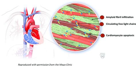 Light Chain Cardiac Amyloidosis Strategies To Promote Early Diagnosis And Cardiac Response Heart