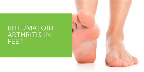 Rheumatoid Arthritis Feet Early Signs