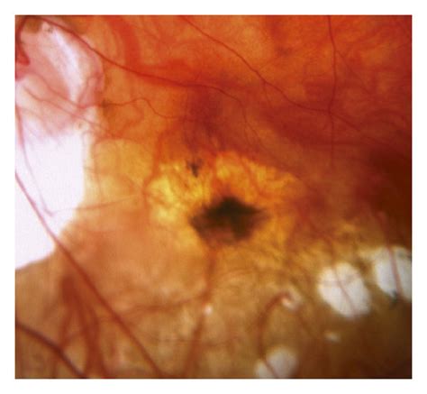 Choroidal Neovascularization In A Patient With Pathological Myopia A Download Scientific