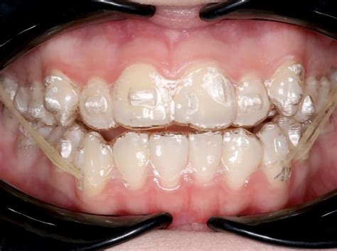 How Invisalign Works The Clear Path To A Straighter Smile
