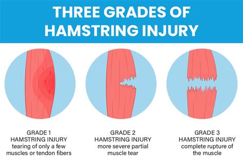 Hamstring Strain Causes Treatment And Recovery Tips