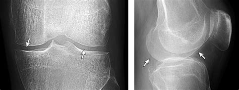 Chondrocalcinosis X Ray