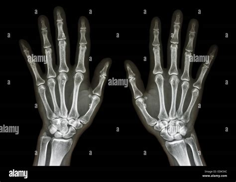 Xray Hand Anatomy