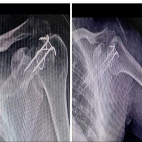 Immediate Post Op X Ray Showing Adequate Reduction Of Acromion Fracture Download Scientific