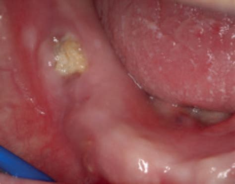 Osteoradionecrosis Of Jaw