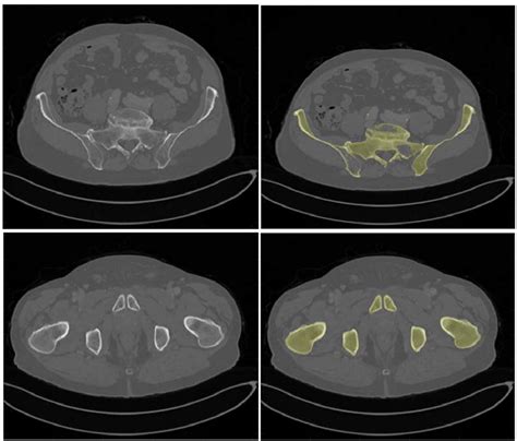 Original Images A C And Segmented Bone B D For The Patient Download Scientific Diagram