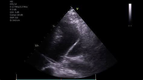 Procedure Details Pericardiocentesis Youtube