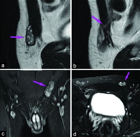 Ovotesticular Disorder Of Sex Development An Unusual Presentation
