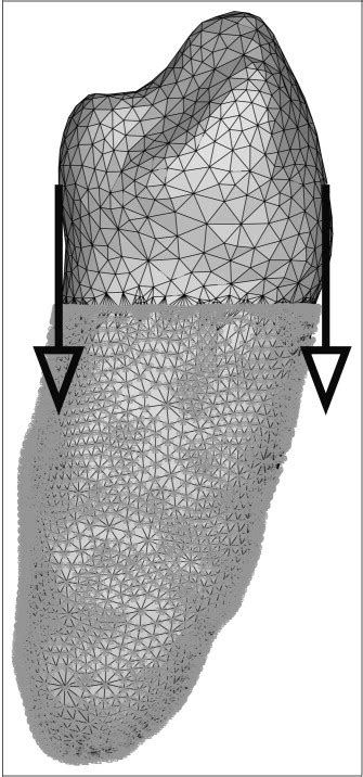 Influence Of Different Modeling Strategies For The Periodontal Ligament On Finite Element