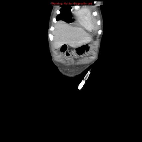 Appendicitis With Phlegmon Radiopaedia 9358 10046 B Nc Commons