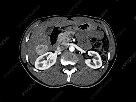 Liver Cancer Ct Scan Stock Image C0261127 Science Photo Library