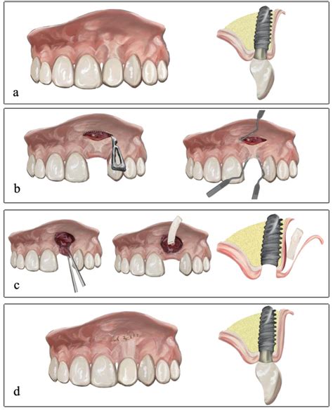 Schematic Diagrams Showing Frontal And Sagittal Sections Of The Apical Download Scientific