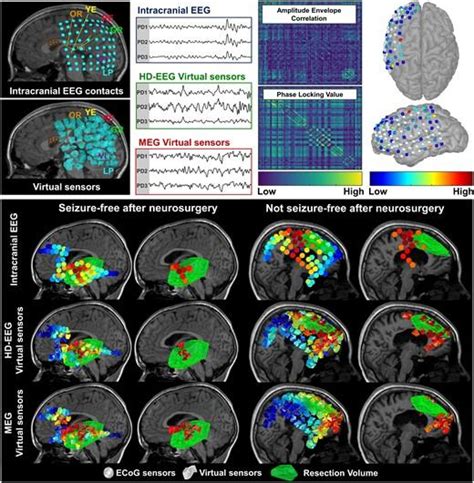 Christos Papadelis On Linkedin Non Invasive Mapping Of Epileptogenic Networks Predicts Surgical