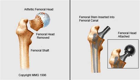 Hip Joint Replacement Surgery Cemented Uncemented Artificial