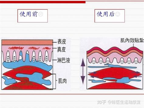 软组织贴扎技术肌内效贴 知乎