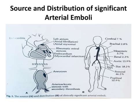 Acute Limb Ischaemia Pptx