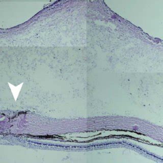 Photomicrographs Of Sections Obtained From A Sclerotomy Site Closed