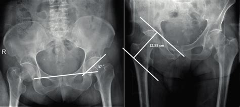 The Sharp Angle Also Known As Acetabular Index Is Formed Between Download Scientific Diagram