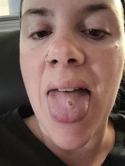 Pyogenic Granuloma From Pregnancy Or Something Else R Askdentists