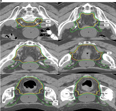 A B Definition Of Ctv On Axial Ct Scans Are Shown Standard Contouring Download Scientific