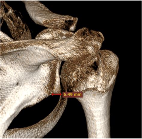 Posterior Glenoid Neck Pgn The 3d Reconstruction Is Positioned Download Scientific Diagram