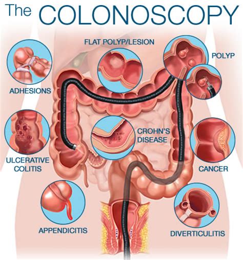 Terminal Ileum Colonoscopy