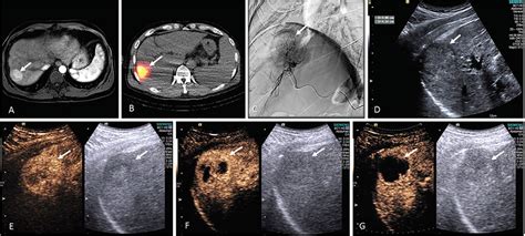 Liver Cancer Ultrasound Liver Cancer Types Of Hepatobiliary Tumors