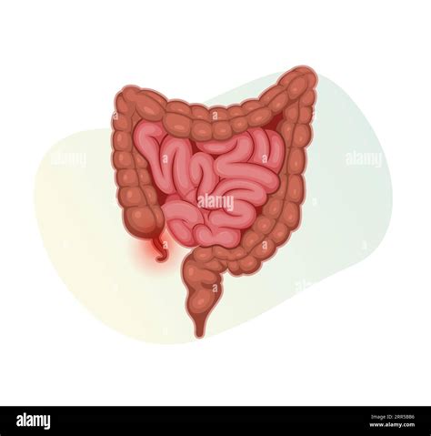 Appendicitis Inflamed Appendix Stock Illustration As Eps 10 File Stock Vector Image And Art