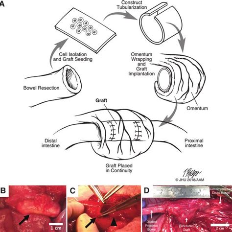 A Illustration Of Surgical Model 2 Double Loop Ostomy Method With Download Scientific Diagram