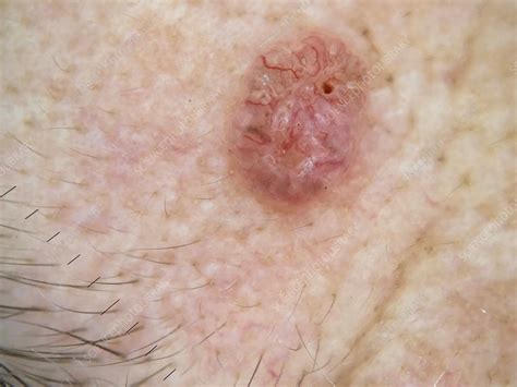 Nodular Bcc Understanding The Importance Of Daily Imaging In The