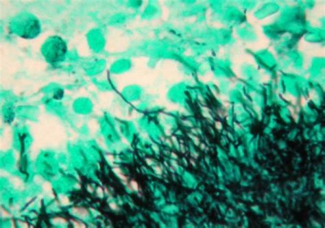 Tissue Gram Stain Demonstrating Elongated Gram Positive Branching Bacilli Download