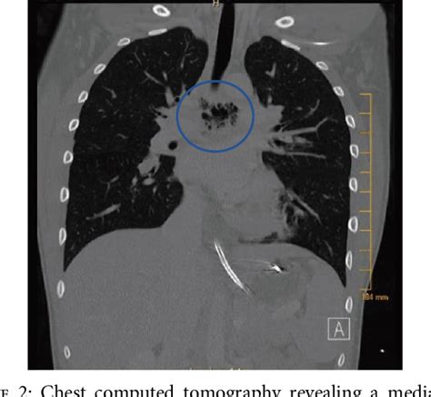 Figure 3 From Brain Abscess Due To Streptococcus Intermedius After Spontaneous Esophageal