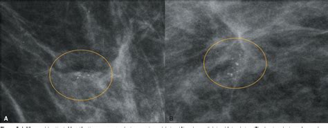 Figure 1 From Amorphous Breast Calcifications Is Bi Rads 4a