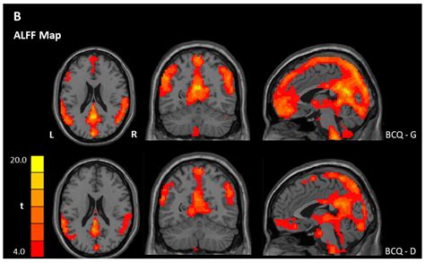 Brain Electrical Activity Mapping Beam The Best Picture Of Beam