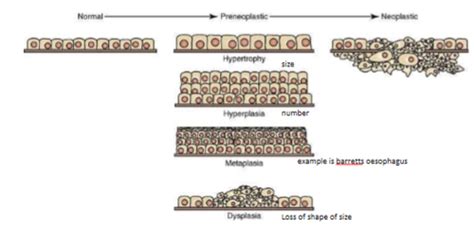 Neoplasia Flashcards Quizlet