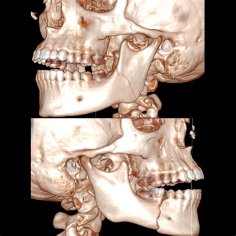 Pediatric Mandibular Fracture Pediatric Radiology Reference Article