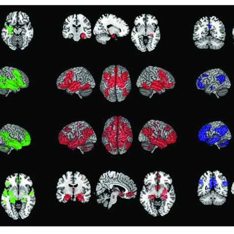 Comparison Of Functional Connectivity Maps Of Mci Atrophy Seeds Download Scientific Diagram