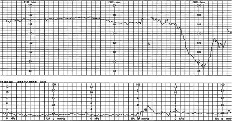 Fetal Heart Rate Monitoring Showed Decreased Variability And Variable