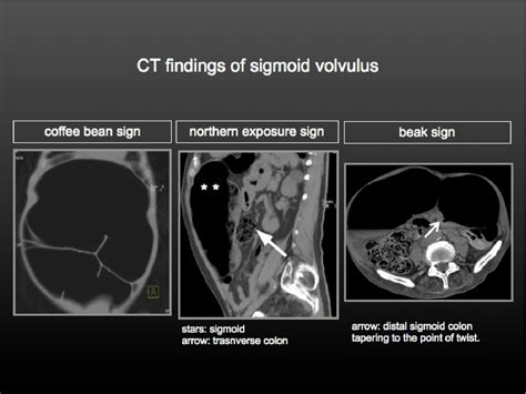 Cecal Volvulus X Ray Coffee Bean
