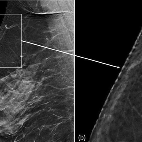 False Negative Calcifications Pleomorphic Calcifications Seen In Download Scientific Diagram