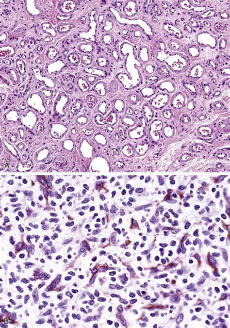 Benign Vascular Tumors And Malformations Basicmedical Key