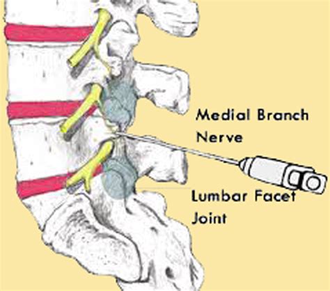 Medial Branch Block Nhs